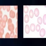 Normocitosis y normocromía. Significados y características