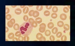 Normocitosis y normocromía. Significados y características